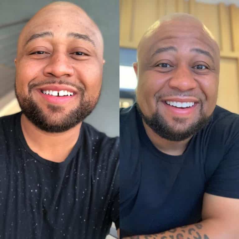 Smile Direct Club Review - Must Read This Before Buying