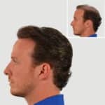 Hair Club Review - Must Read This Before Buying