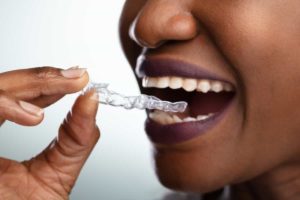 Byte Aligners Review - Must Read This Before Buying