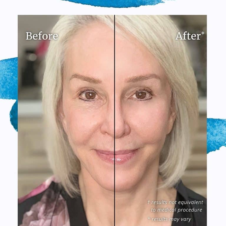 Plexaderm Review - Must Read This Before Buying