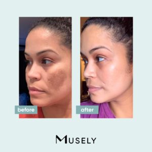 Musely Skincare Review - Must Read This Before Buying