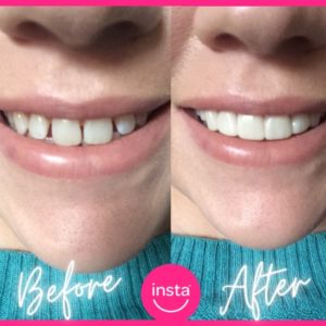 Instasmile Review - Must Read This Before Buying