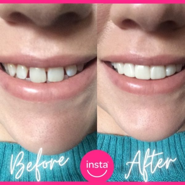 Instasmile Review - Must Read This Before Buying