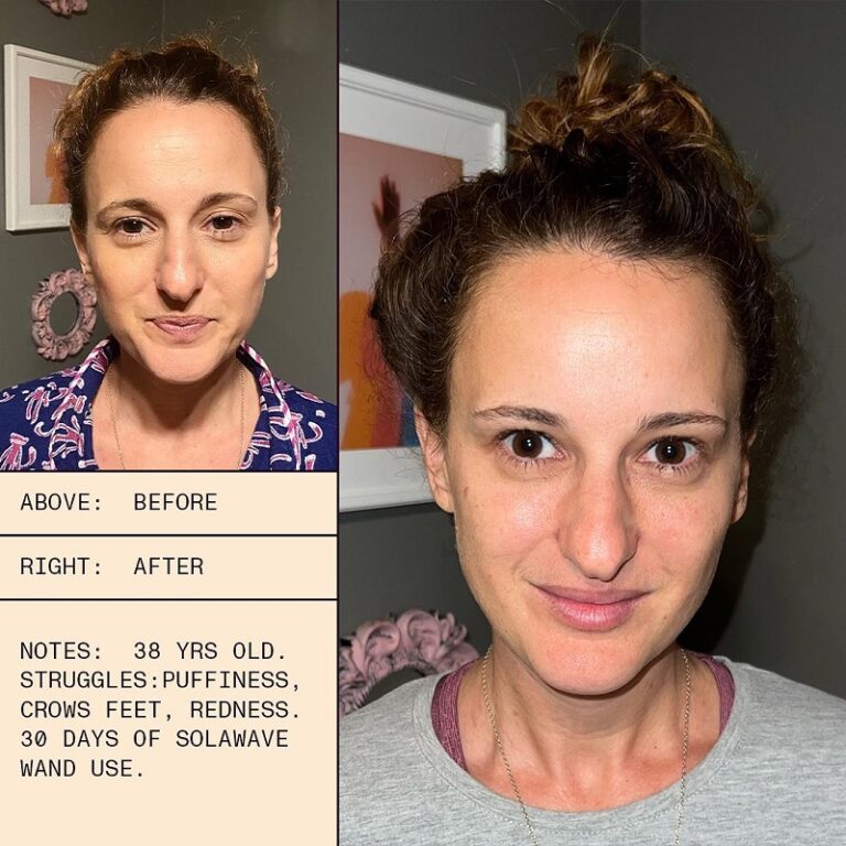 30 SolaWave Before and After Pictures - Must Read This Before Buying