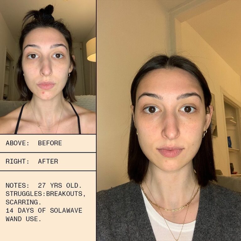 30 SolaWave Before and After Pictures - Must Read This Before Buying