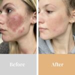 Red Light Therapy Before and After: Does It Really Work? - Must Read ...