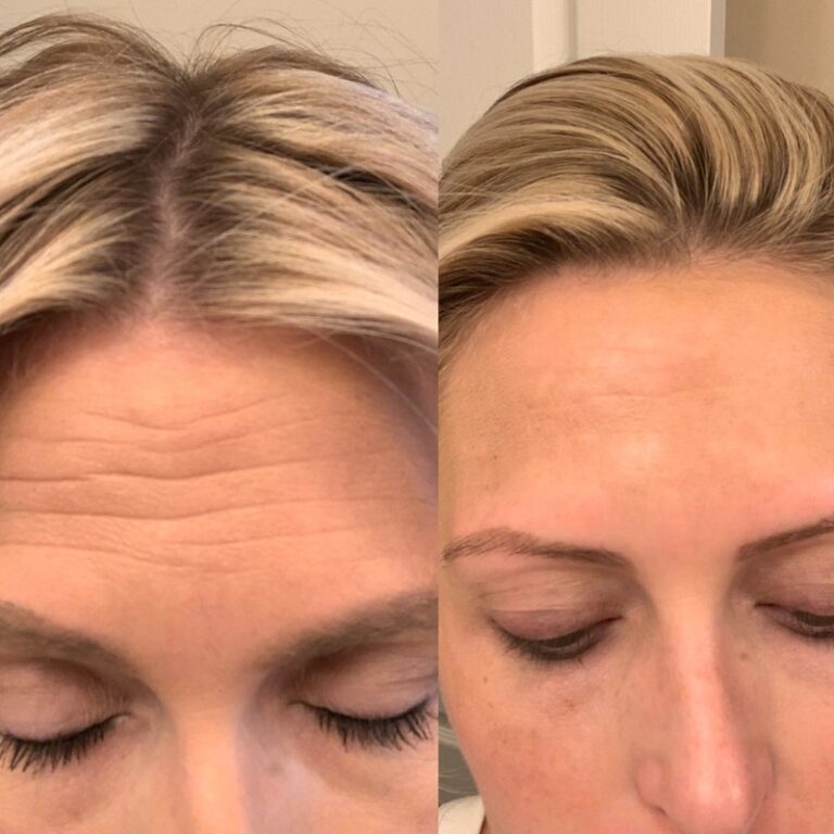 Botox Before and After: Dramatic Results and What to Expect - Must Read ...