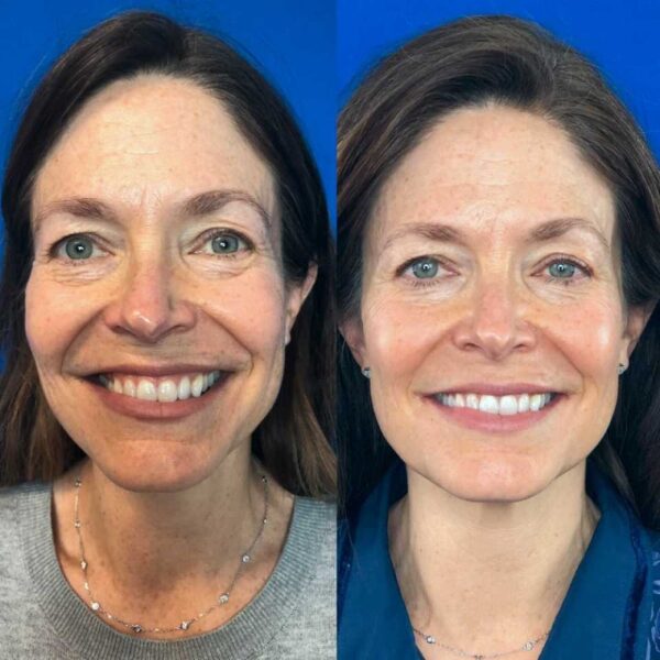 Tretinoin Before and After: A Comprehensive Analysis of its ...