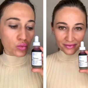 The Ordinary Peeling Solution Before and After: A Comprehensive Review ...
