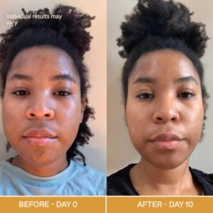 Red Light Therapy Before and After: Does It Really Work? - Must Read ...