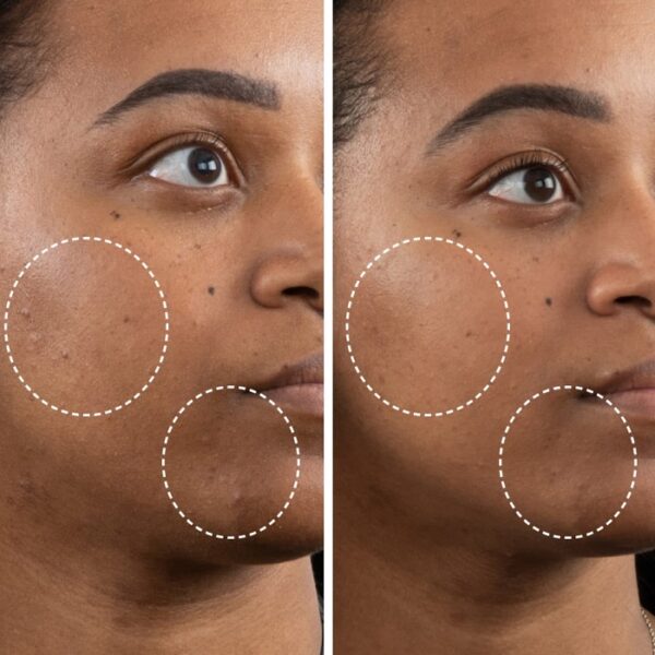 Retinol Before and After: Transform Your Skin with These Results - Must ...