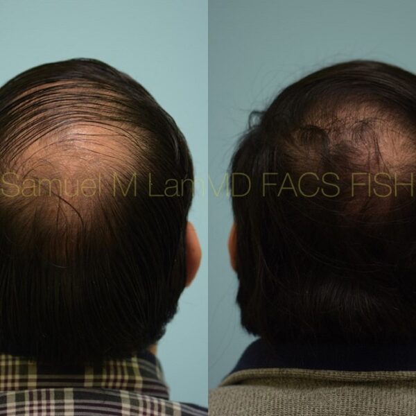 Minoxidil Before and After: Real Results and Photos - Must Read This ...