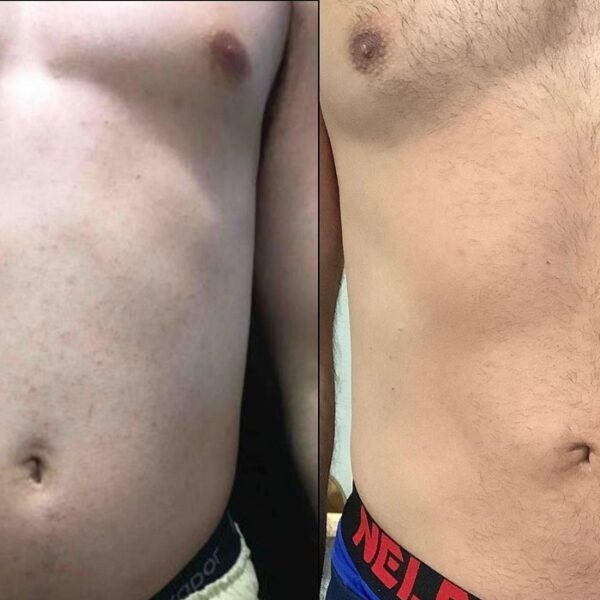 Coolsculpting Before and After: Results, Side Effects, and What to ...