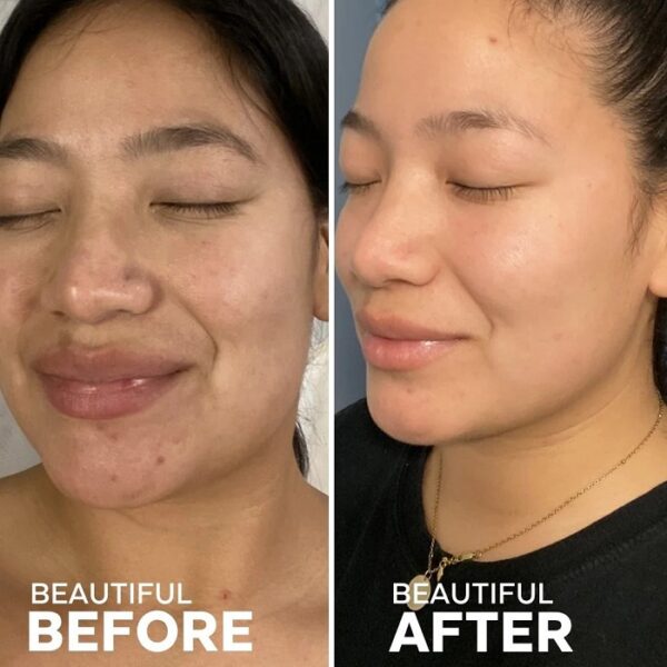 Retinol Before and After: Transform Your Skin with These Results - Must ...