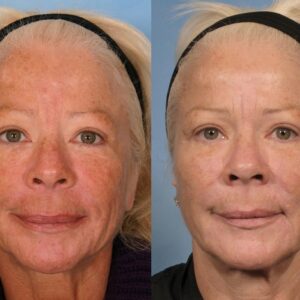 Sculptra Before and After: Transforming Your Appearance with Long ...
