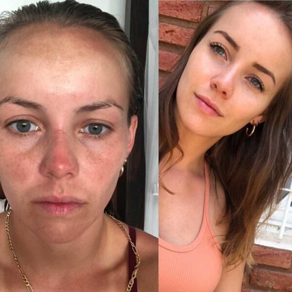 Retinol Before and After: Transform Your Skin with These Results - Must ...