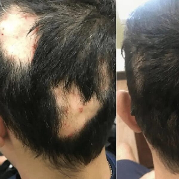Minoxidil Before and After: Real Results and Photos - Must Read This ...