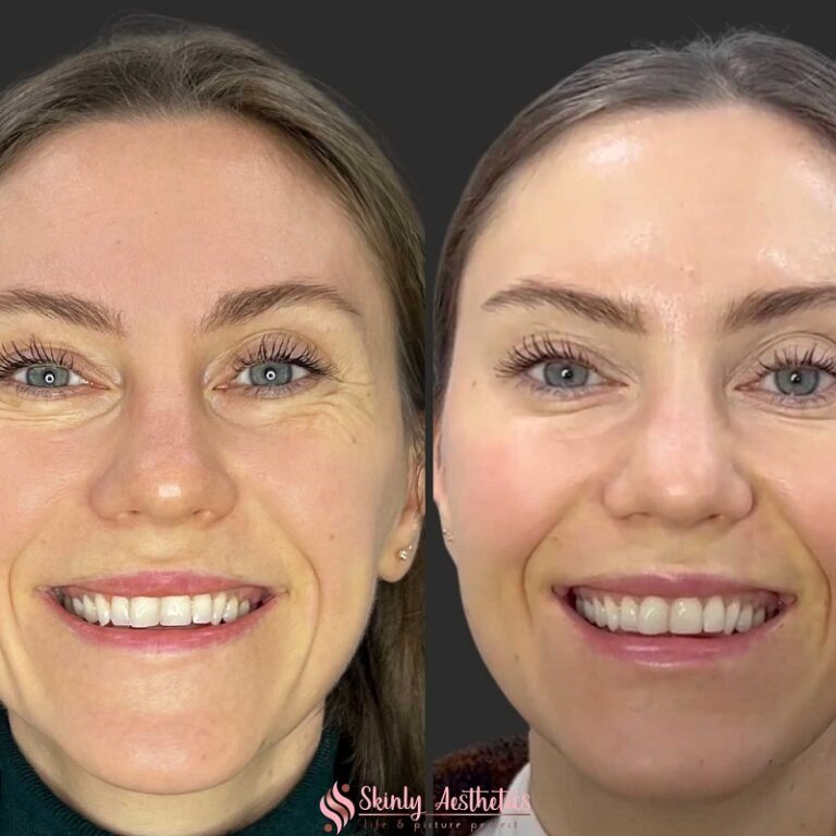 Botox Before and After: Dramatic Results and What to Expect - Must Read ...