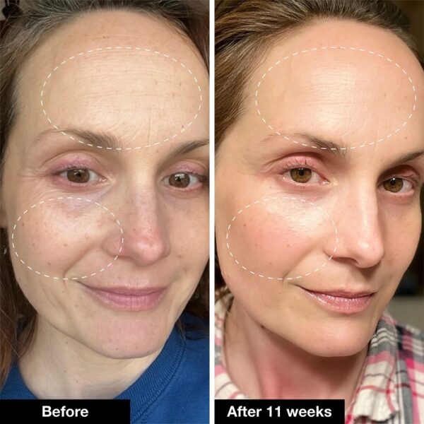 Retinol Before And After Transform Your Skin With These Results Must Read This Before Buying