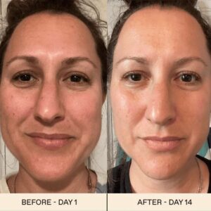 Red Light Therapy Before and After: Does It Really Work? - Must Read ...