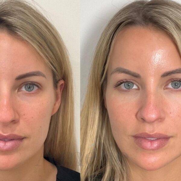 Sculptra Before and After: Transforming Your Appearance with Long ...