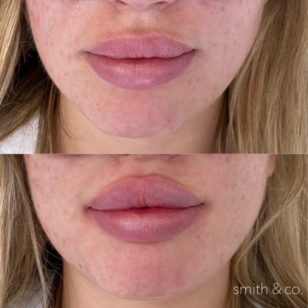 Lip Lift Before and After: Dramatic Results and Recovery Process - Must ...