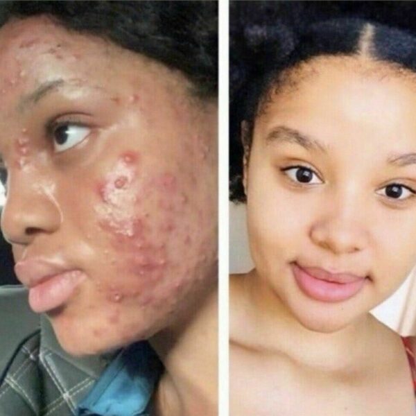 Kojic Acid Soap Before and After: Does It Really Lighten Skin? - Must ...