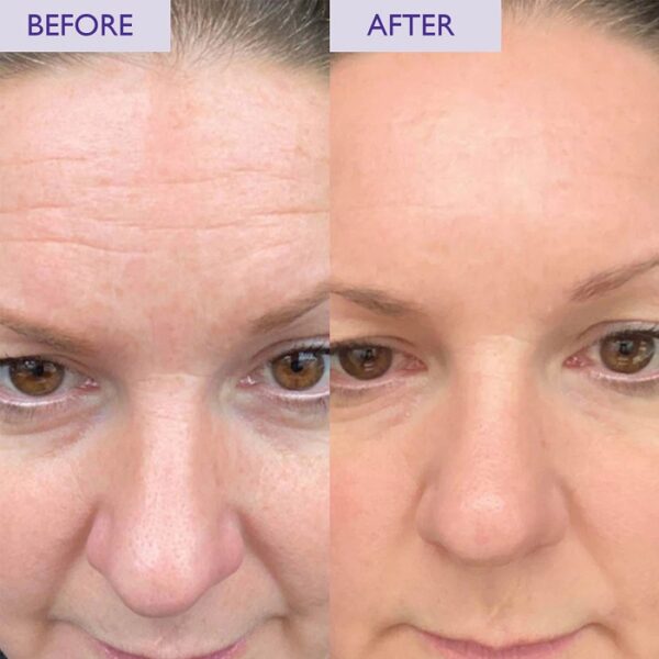 Retinol Before and After: Transform Your Skin with These Results - Must ...