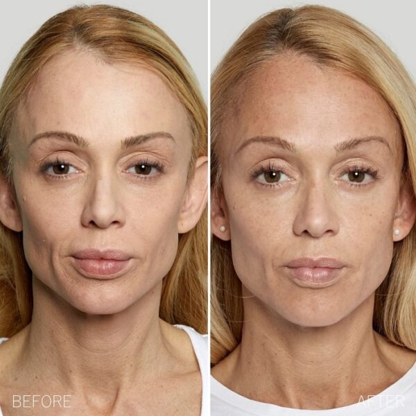 Sculptra Before and After: Transforming Your Appearance with Long ...