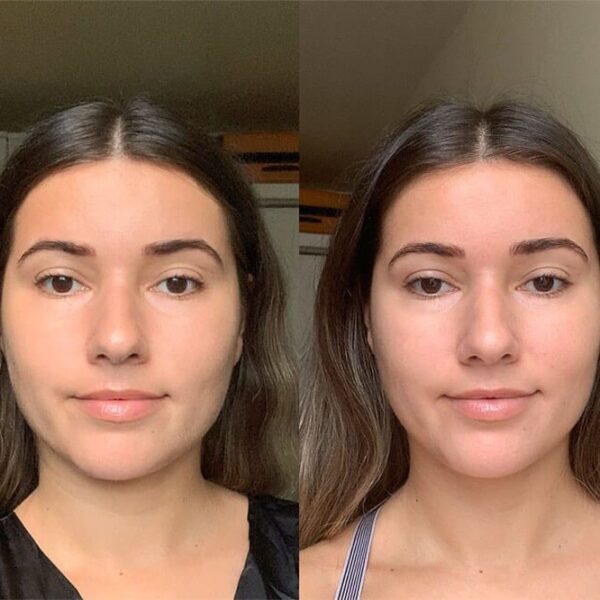 Red Light Therapy Before and After: Does It Really Work? - Must Read ...