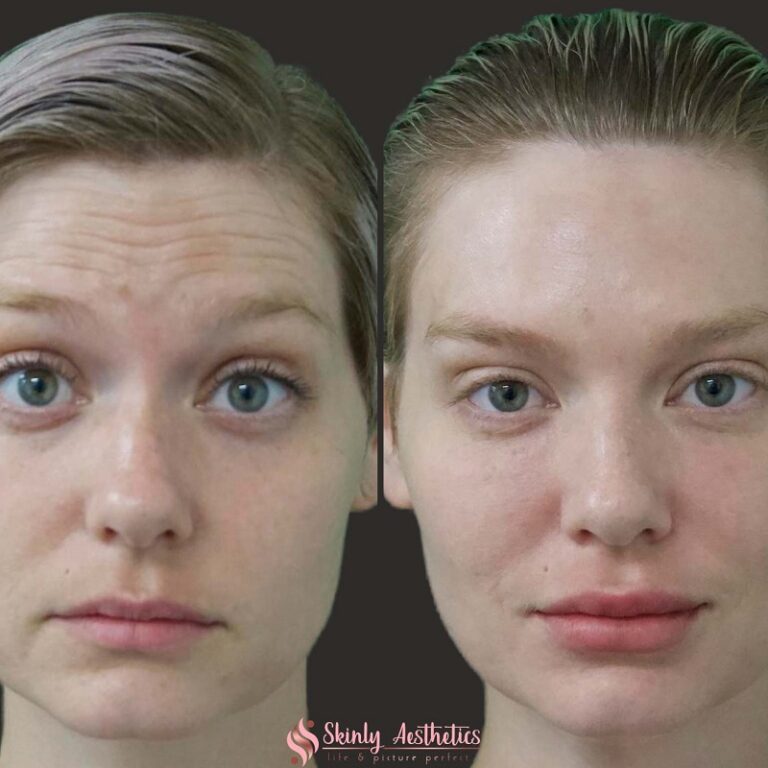 Botox Before and After: Dramatic Results and What to Expect - Must Read This Before Buying