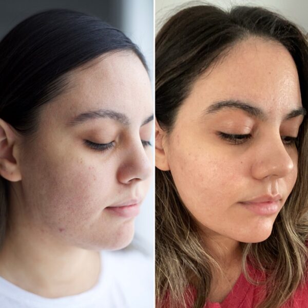 Retinol Before and After: Transform Your Skin with These Results - Must ...