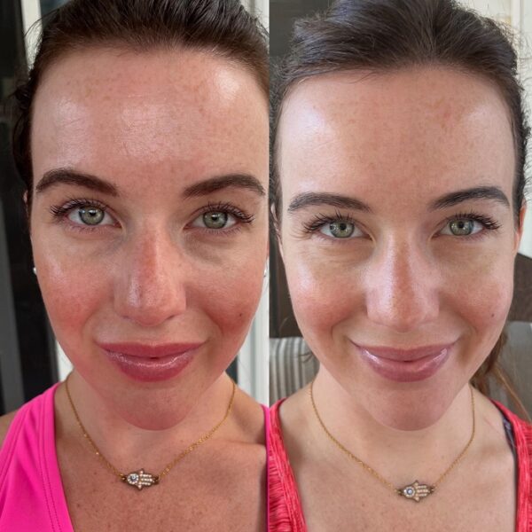 Red Light Therapy Before and After: Does It Really Work? - Must Read ...