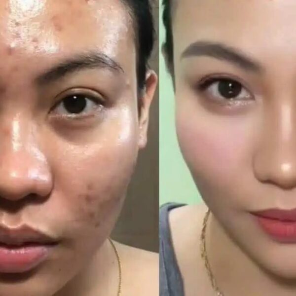 Tretinoin Before and After: A Comprehensive Analysis of its Effectiveness on Skin - Must Read ...