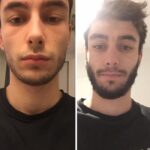 Minoxidil Before and After: Real Results and Photos - Must Read This ...