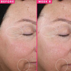 Retinol Before and After: Transform Your Skin with These Results - Must ...
