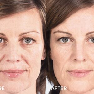 Red Light Therapy Before and After: Does It Really Work? - Must Read ...