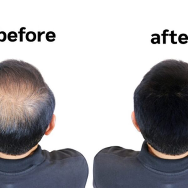 Minoxidil Before and After: Real Results and Photos - Must Read This ...