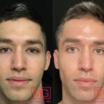 Sculptra Before and After: Transforming Your Appearance with Long ...