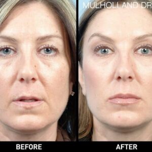 Sculptra Before and After: Transforming Your Appearance with Long ...
