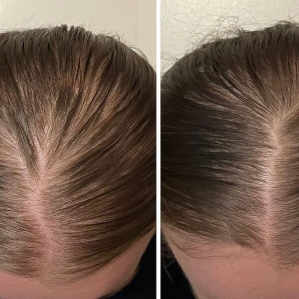 Minoxidil Before and After: Real Results and Photos - Must Read This ...