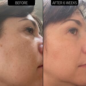 Retinol Before and After: Transform Your Skin with These Results - Must ...