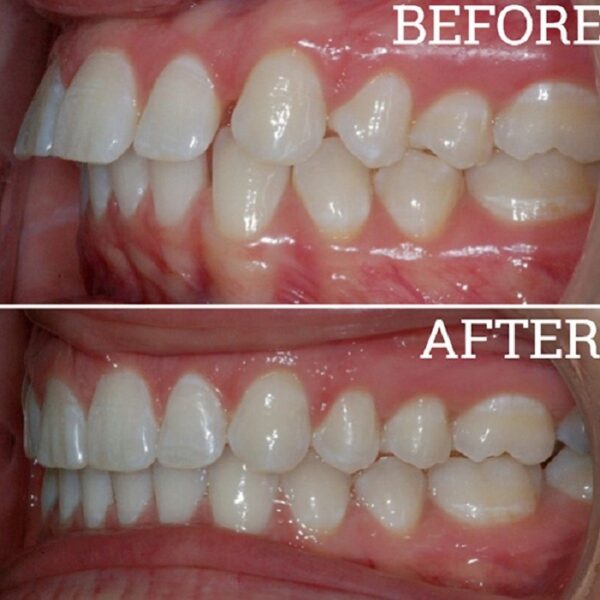 Invisalign Before and After: Transforming Your Smile with Clear ...