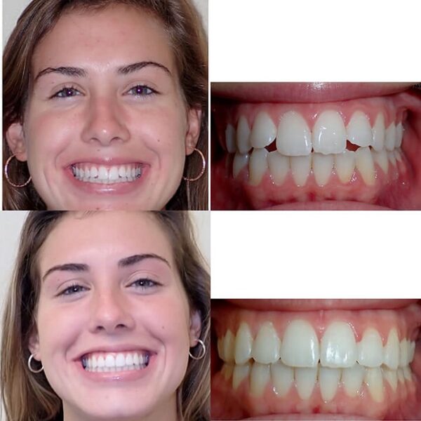 Invisalign Before and After: Transforming Your Smile with Clear ...