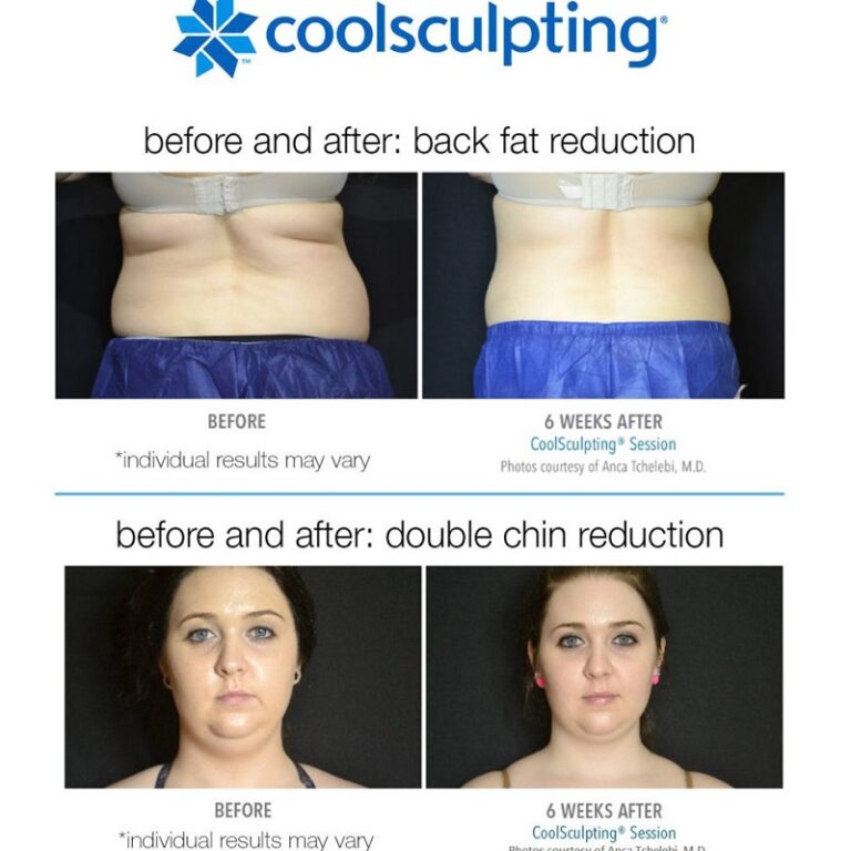 Coolsculpting Before and After: Results, Side Effects, and What to ...