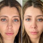 Red Light Therapy Before and After: Does It Really Work? - Must Read ...