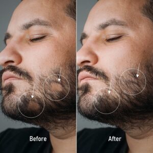 Minoxidil Before and After: Real Results and Photos - Must Read This ...