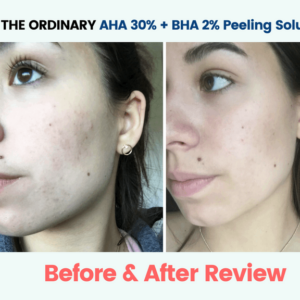 The Ordinary Peeling Solution Before and After: A Comprehensive Review ...
