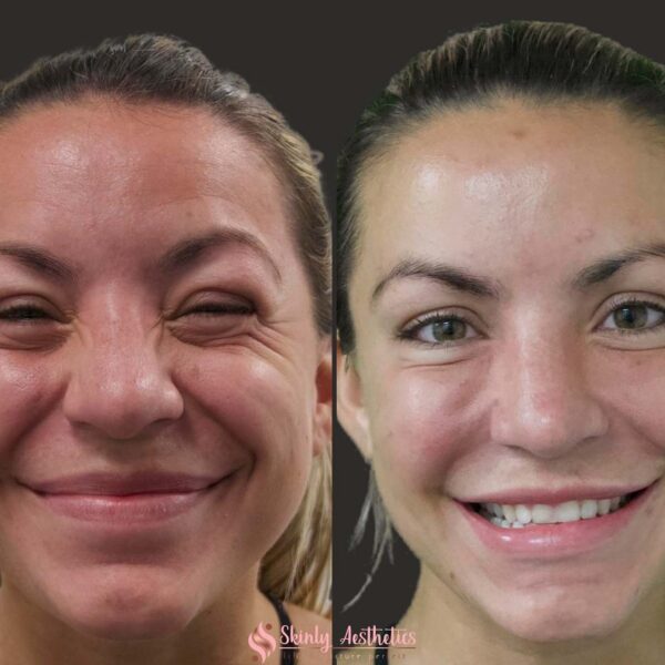 Botox Before and After: Dramatic Results and What to Expect - Must Read ...