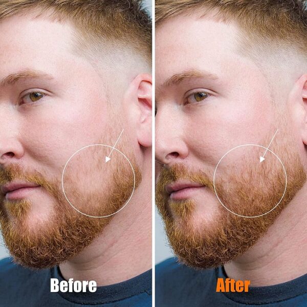 Minoxidil Before and After: Real Results and Photos - Must Read This Before Buying